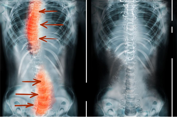 Omurga Deformitesi Nedir? Tedavi Yöntemleri Nelerdir? - Op. Dr. Gokhan ...