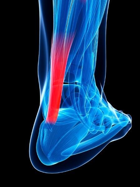 Aşil Tendonu Zedelenmesi Nedir? - Op. Dr. Gokhan Serbes